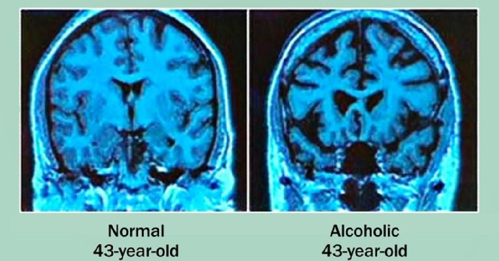 It’s no secret that alcohol affects the brain. It can cause blurry ... It’s no secret that alcohol affects the brain. It can cause blurry ...