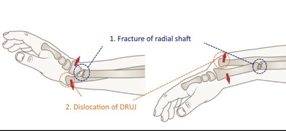 Galeazzi Fracture