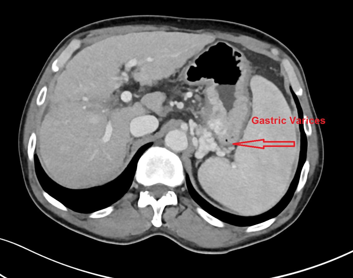 Gastric Varices Ct