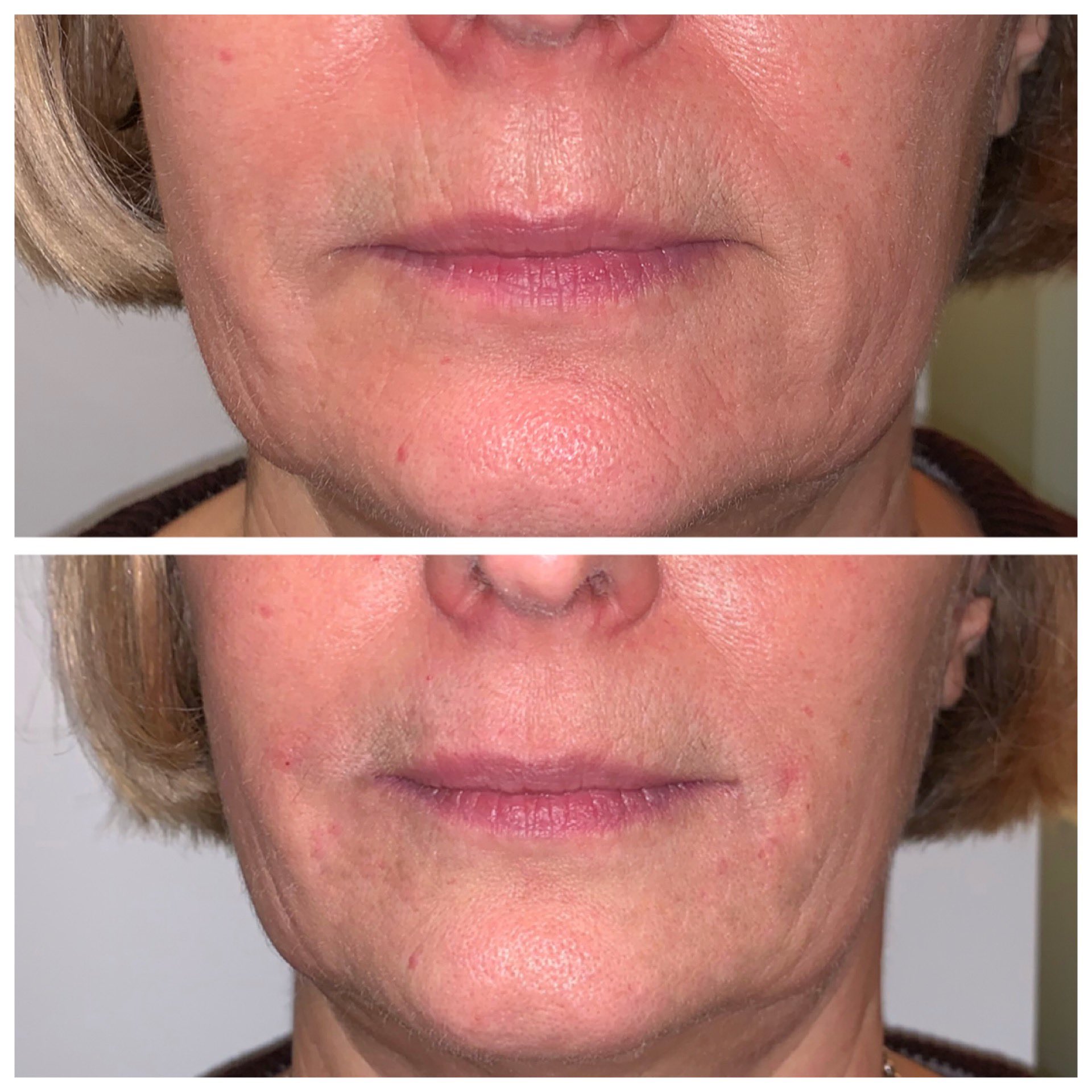 Depressor Anguli Oris