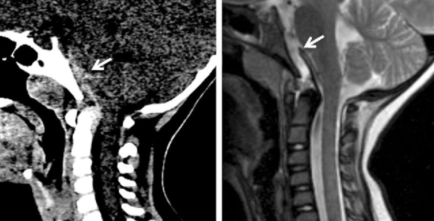 Tectorial Membrane Mri