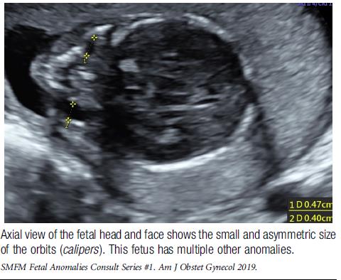 Microphthalmia Ultrasound