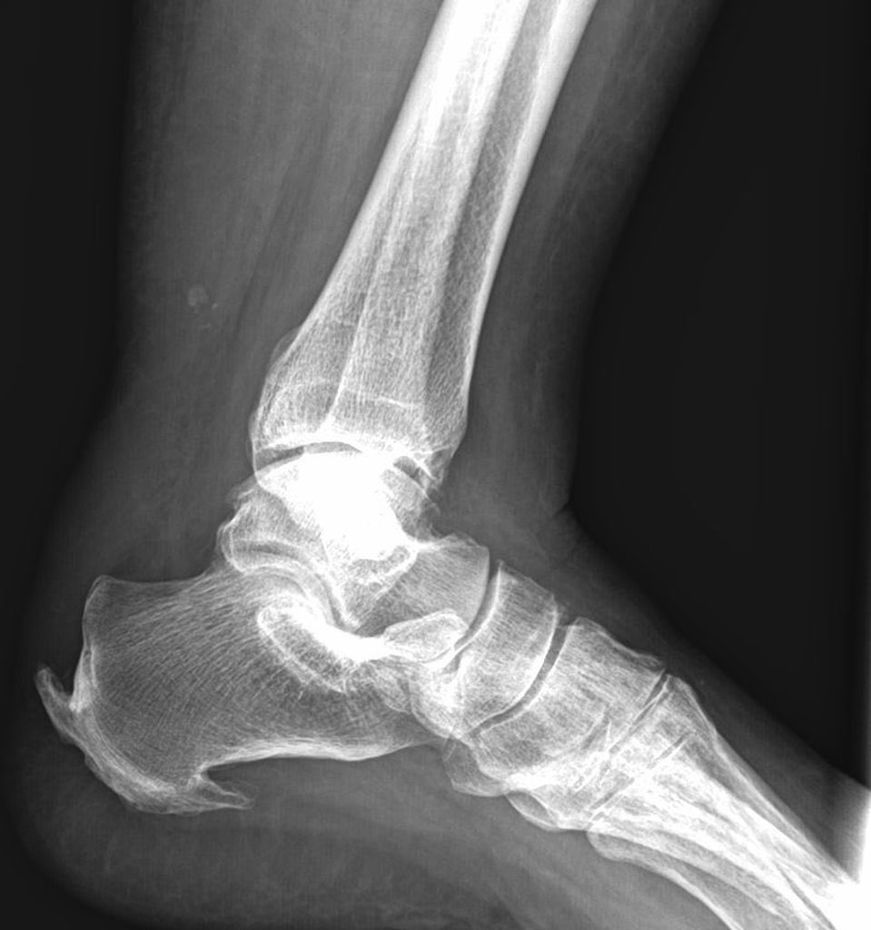 Achilles Tendon Tear X Ray