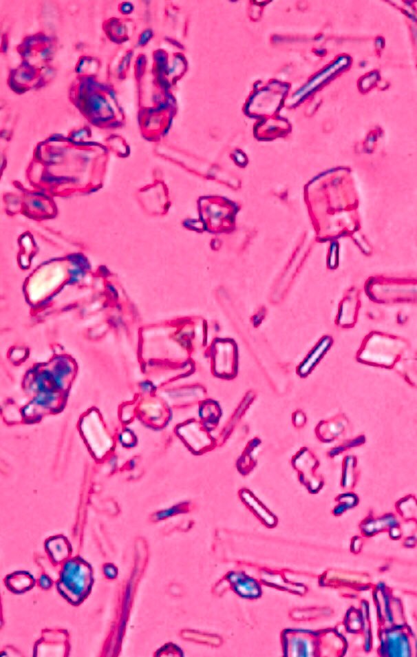 Calcium Pyrophosphate Crystals