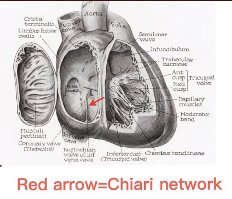 Chiari Network Vs Eustachian Valve