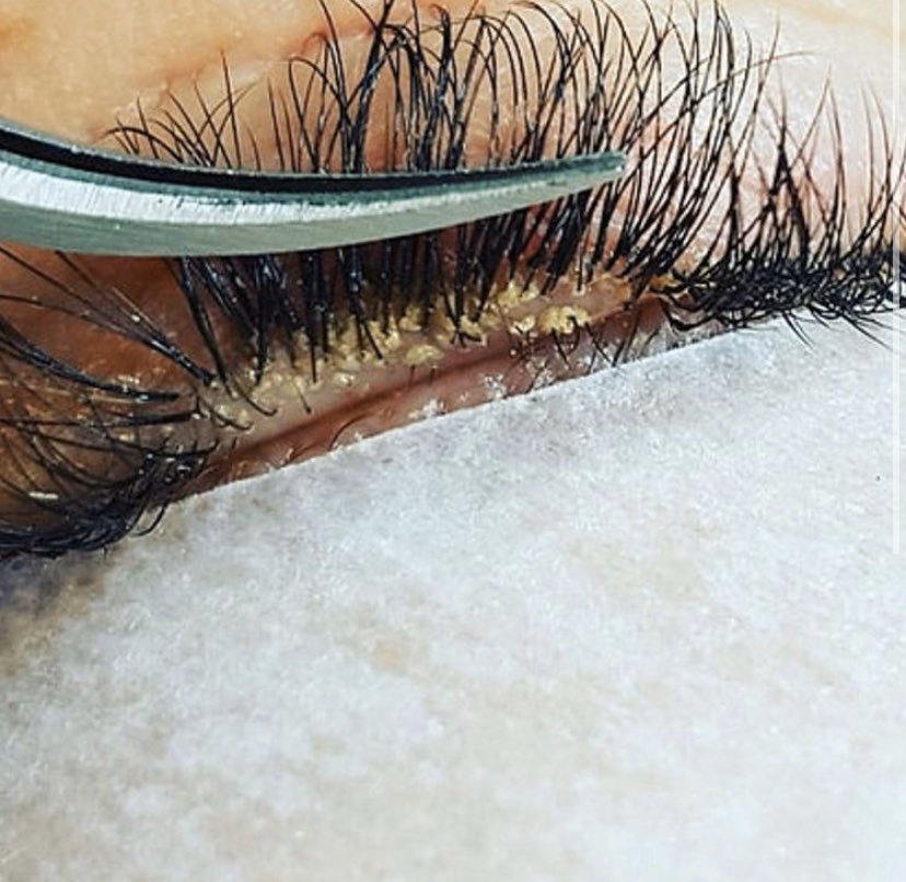 Lice In Eyelashes