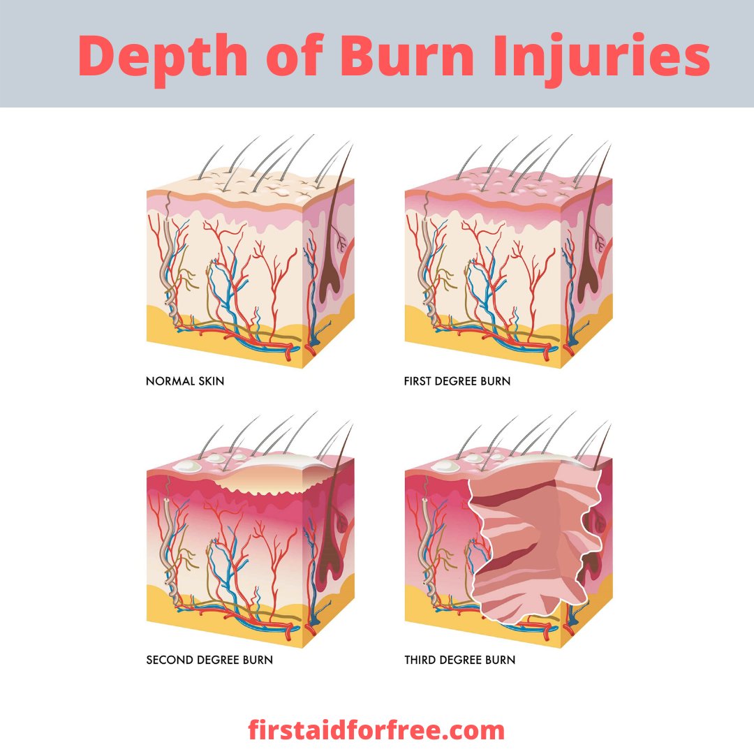 First Degree Burns Diagram