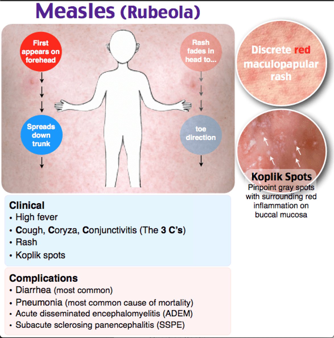 Maculopapular Rash Measles