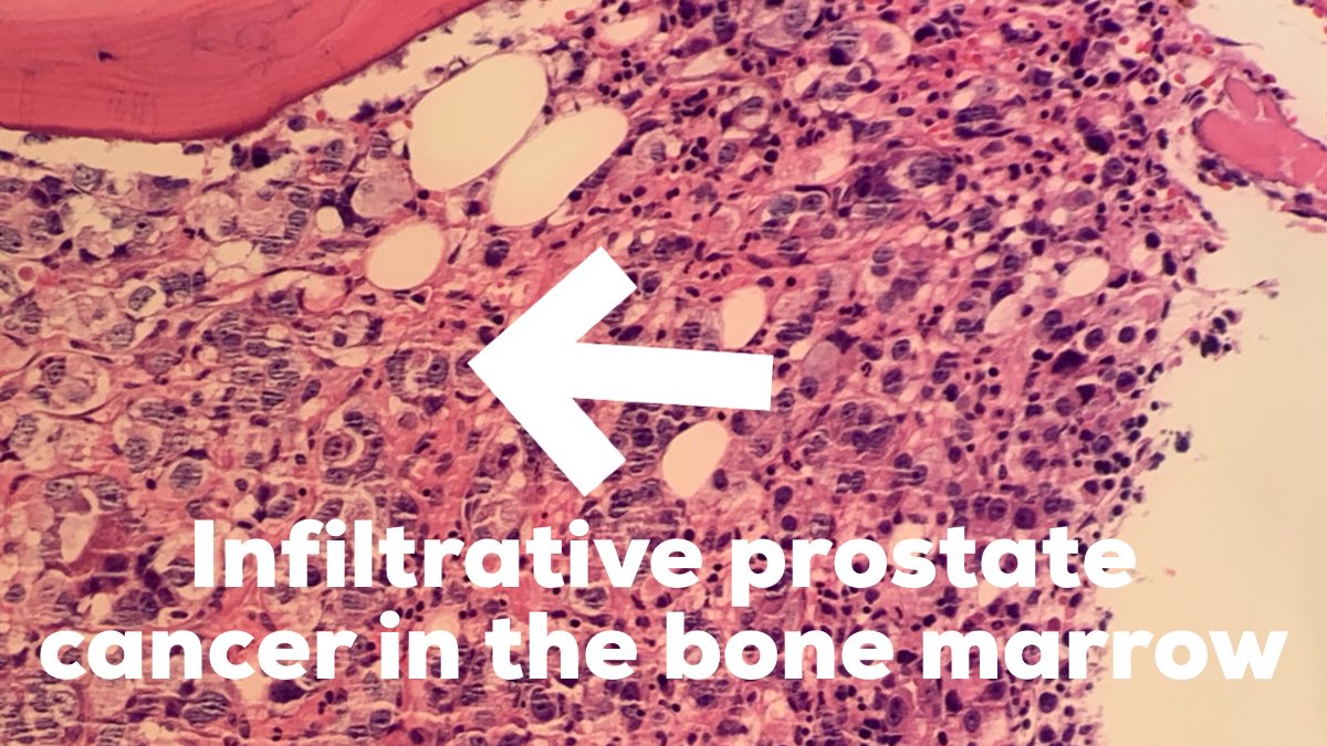 Prostate Biopsy Slides