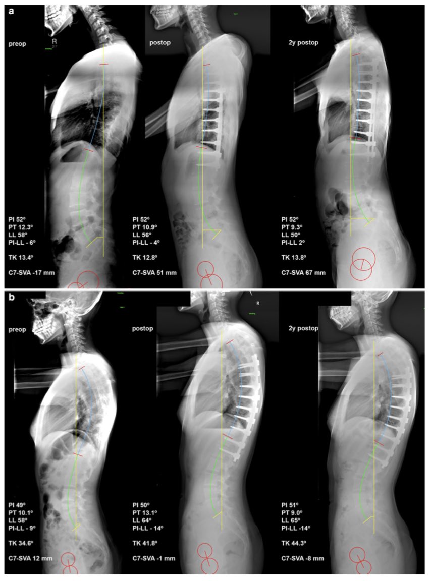 Thoracic Kyphosis