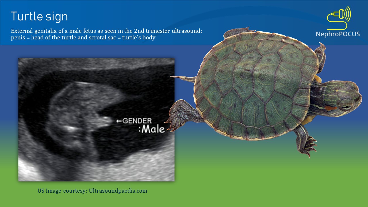 Turtle Sign Ultrasound