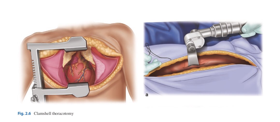 Clamshell Thoracotomy