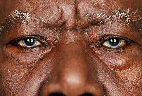 Brown Eyes With Blue Ring Around Iris