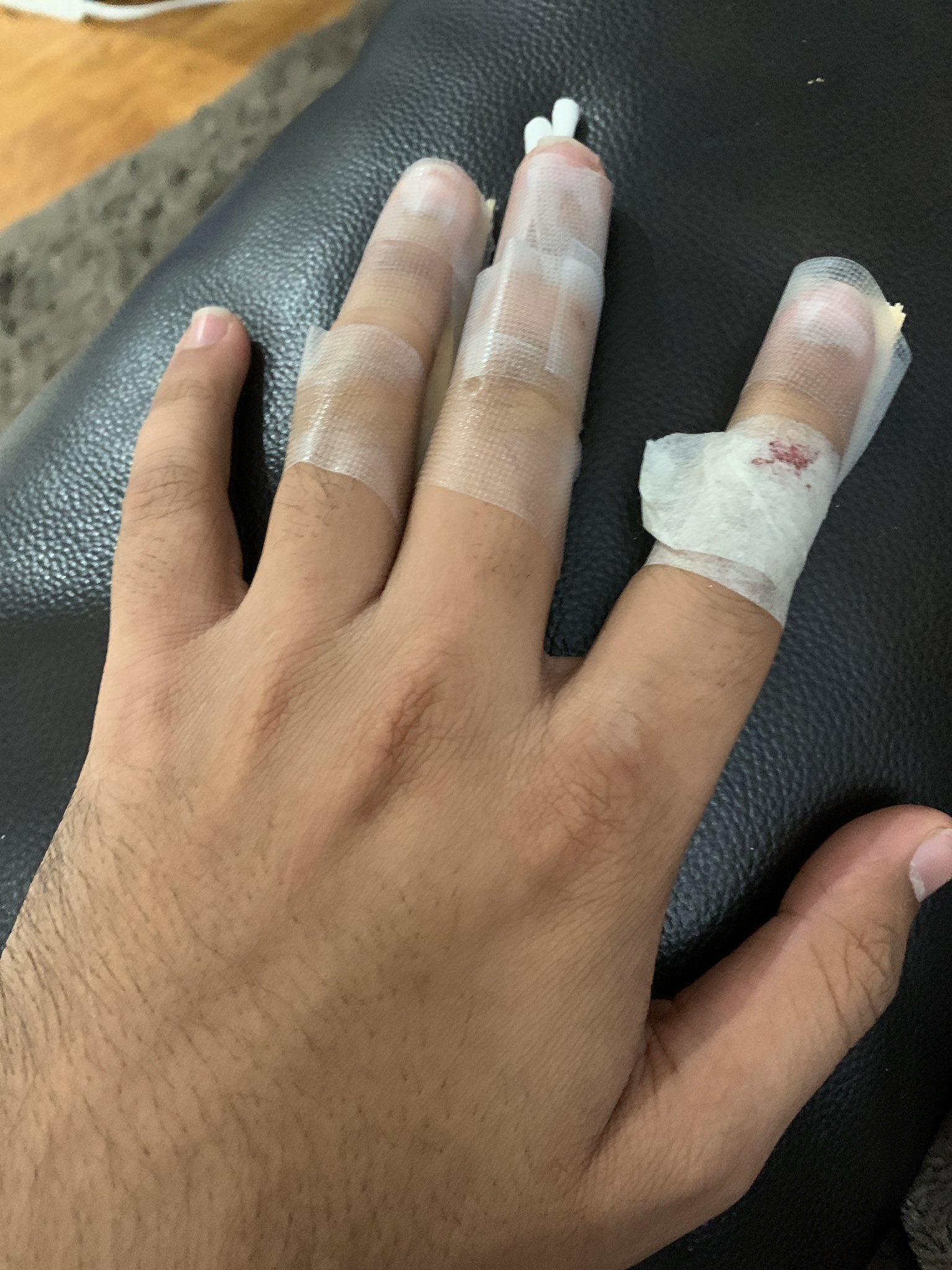 Internal Bleeding Hand