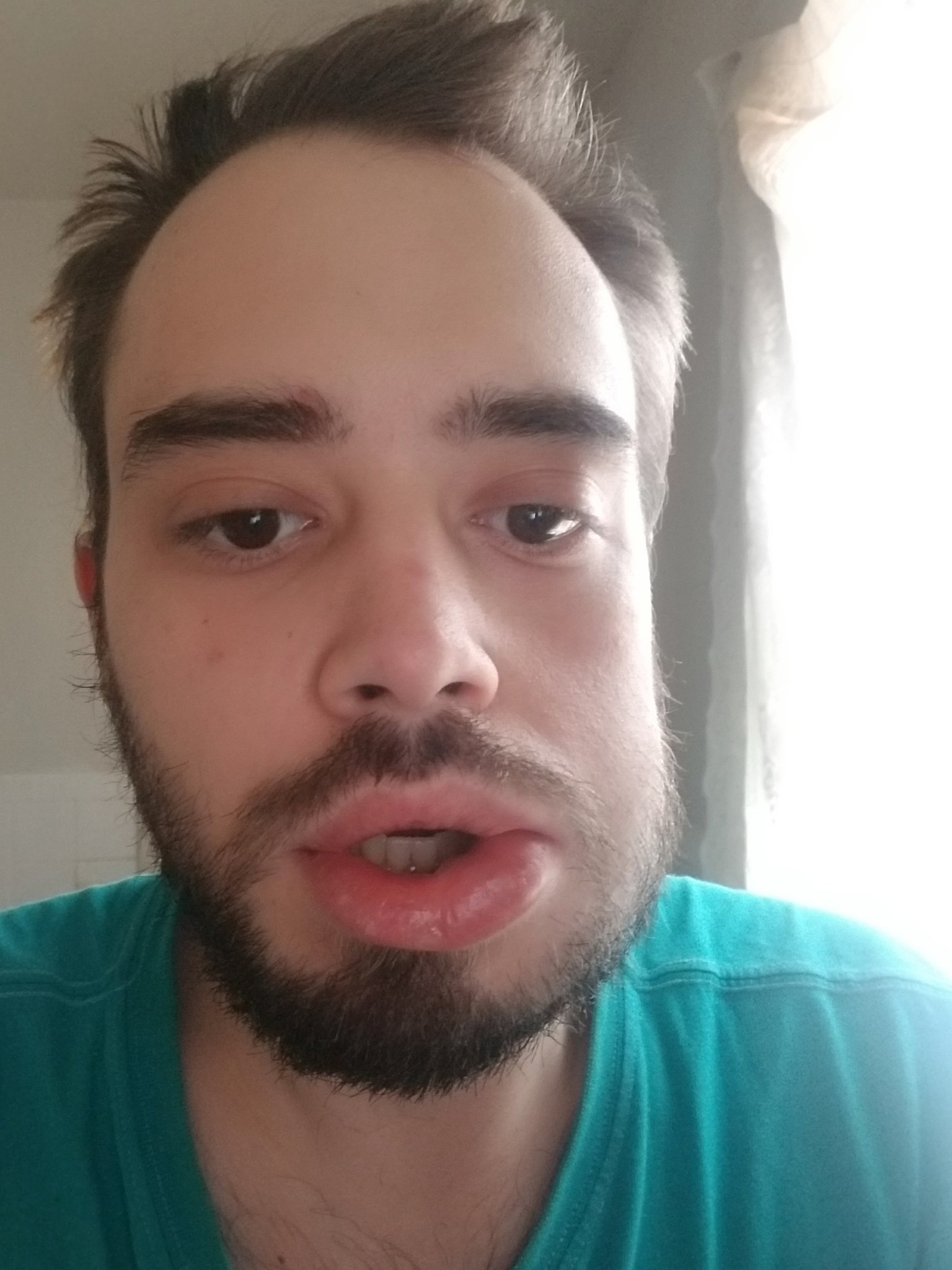 Swollen Left Side Face