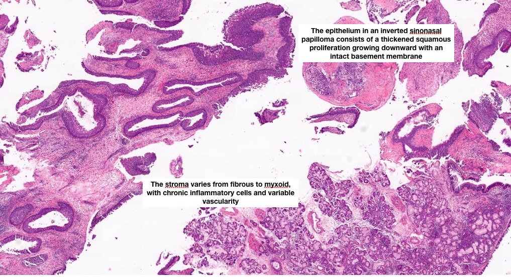 Papillomatosis Histology