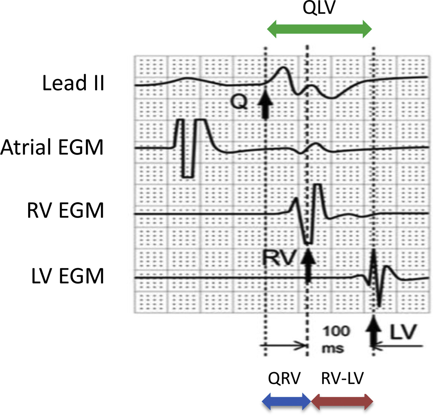 HeartRhythm on Twitter: "Methods - A subset of 419 pts from SMART-AV study comprised QLV RV-LV ...