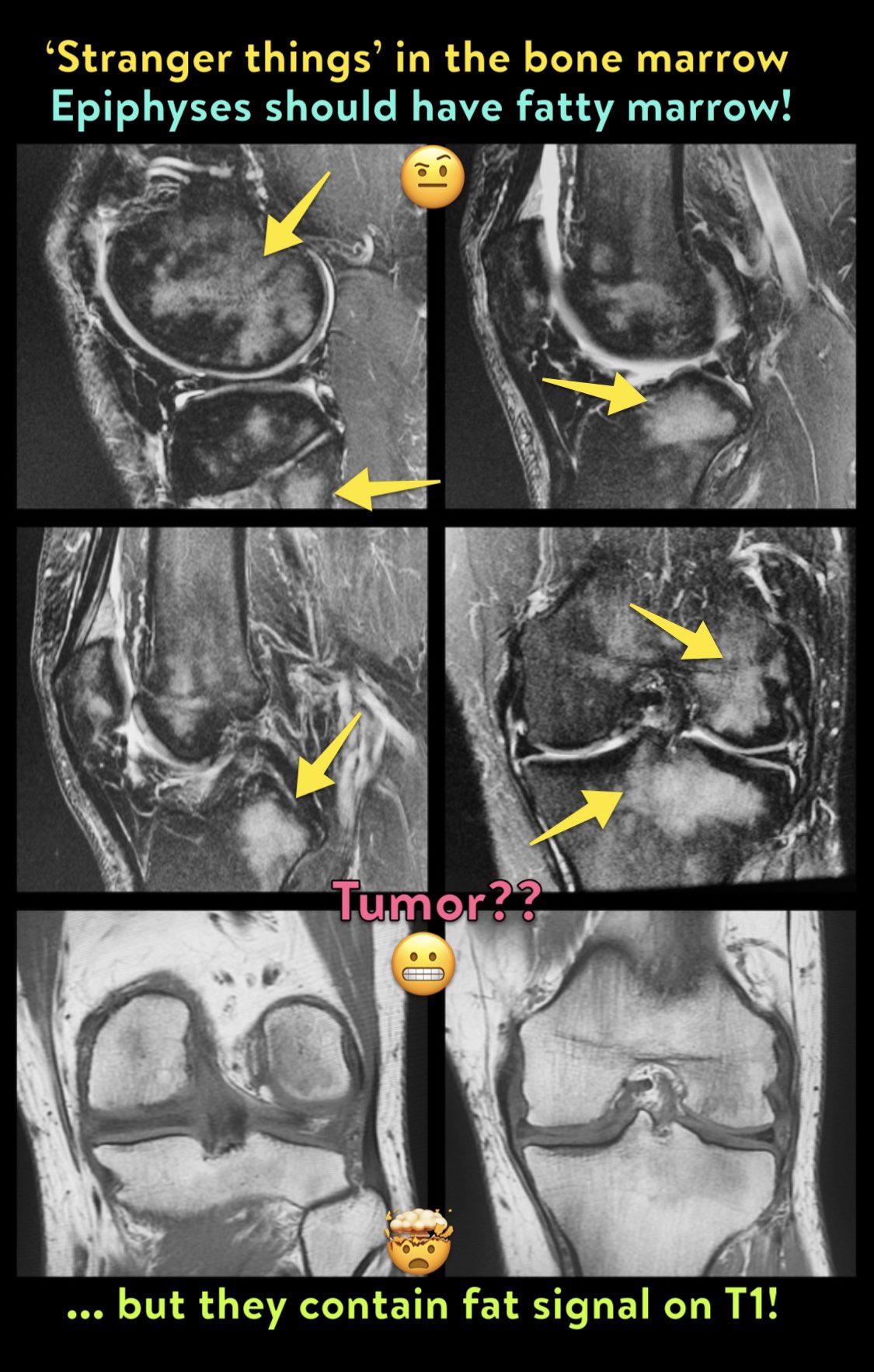 Mri Knee Cartilage Damage