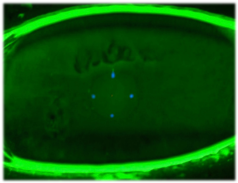 Epithelial Basement Membrane Dystrophy