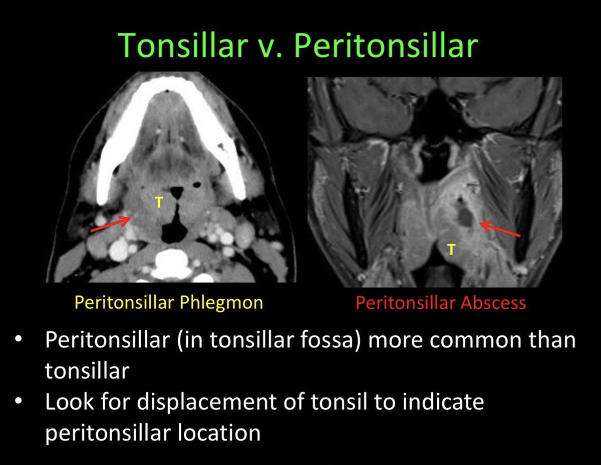Peritonsillar Abscess X Ray