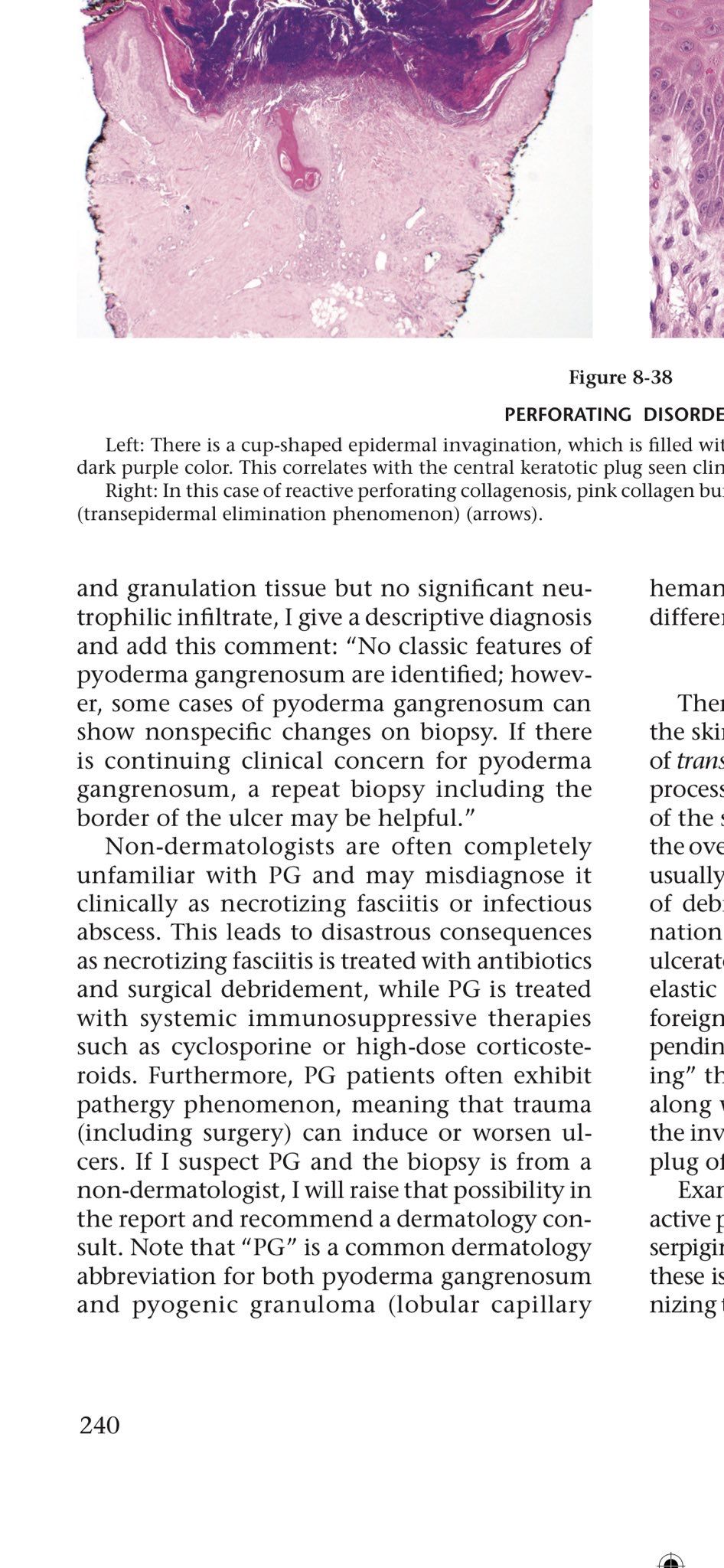 Jerad Gardner, MD on Twitter: "How I handle nonspecific ulcers on biopsy to rule out pyoderma ...
