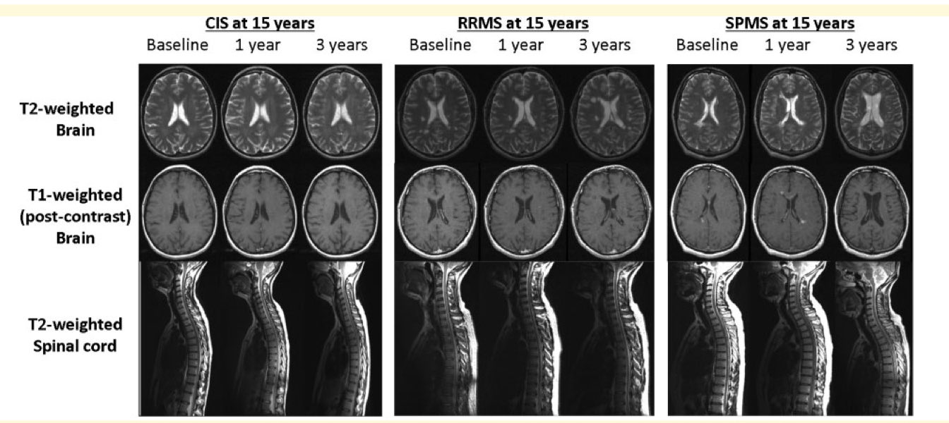 Early Multiple Sclerosis Mri