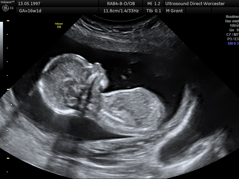 Its A Girl Ultrasound 16 Weeks