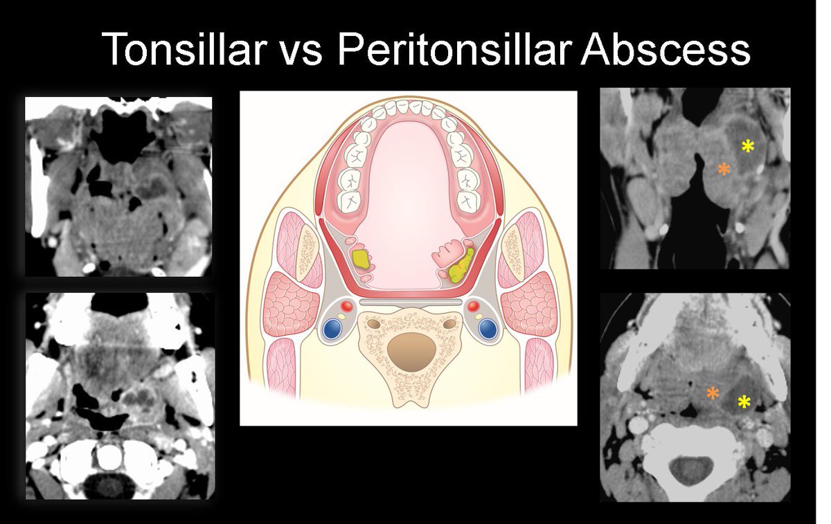 Peritonsillar Abscess Anatomy