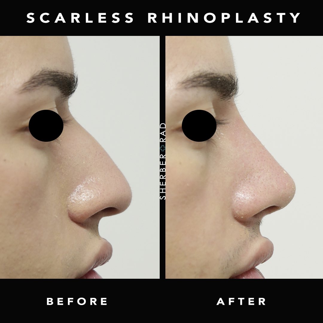 Rhinoplasty Recovery Day 7