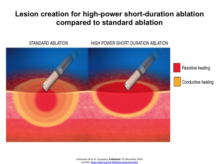 Raviele Antonio on Twitter: "High-power short-duration (70 W for 5–7 s) AF ablation is as safe ...