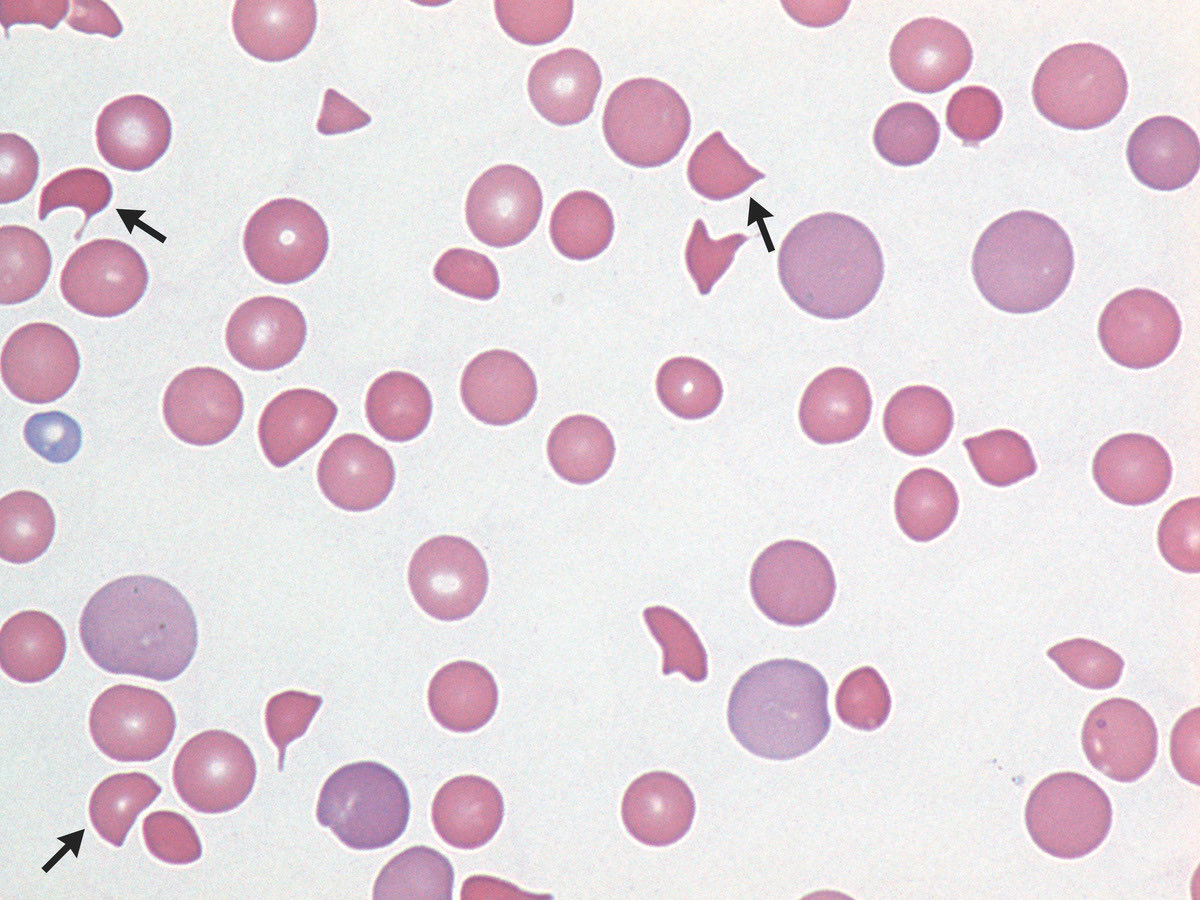 Schistocyte
