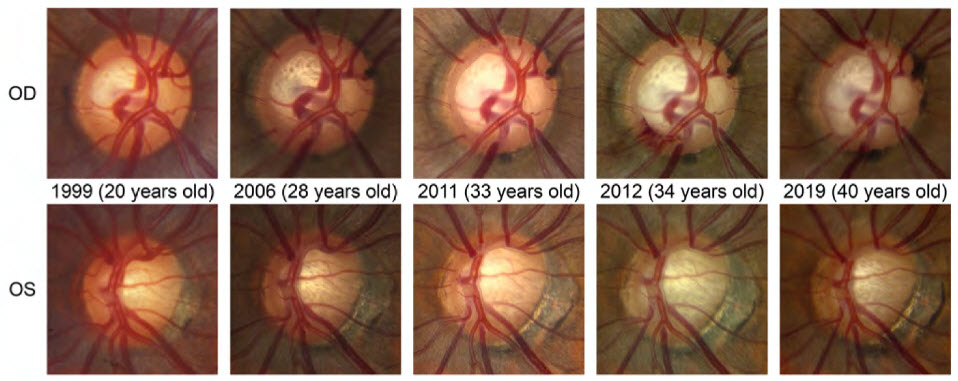 Optic Nerve Cupping Progression Moran CORE | Glaucomatous Cupping