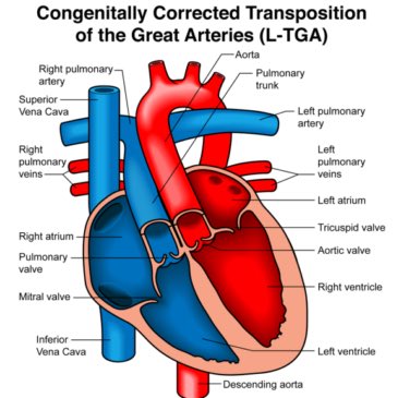D Transposition Of The Great Arteries
