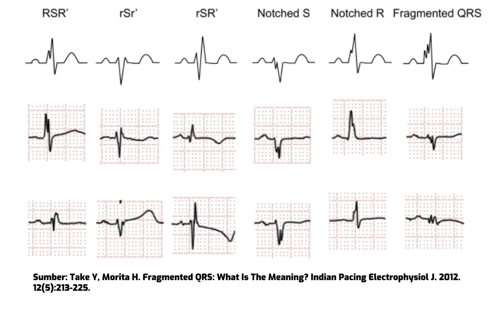 Makna Klinis Fragmented QRS Alomedika, 43% OFF