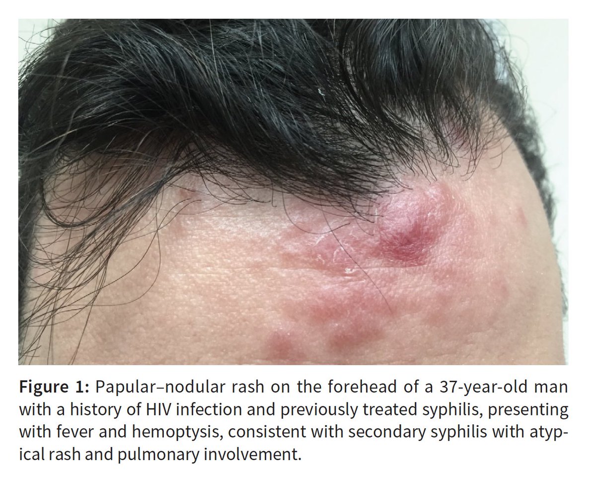 Syphilis Rash On Stomach syphilis-rash-on-stomach