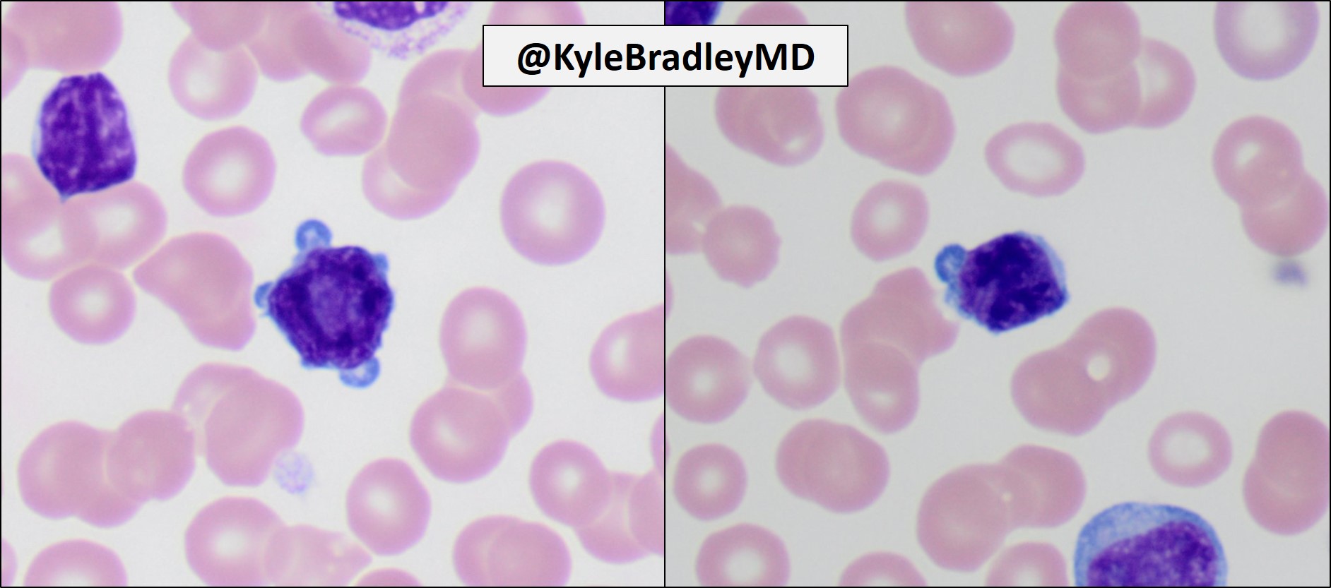 Pro Lymphocytic Leukemia