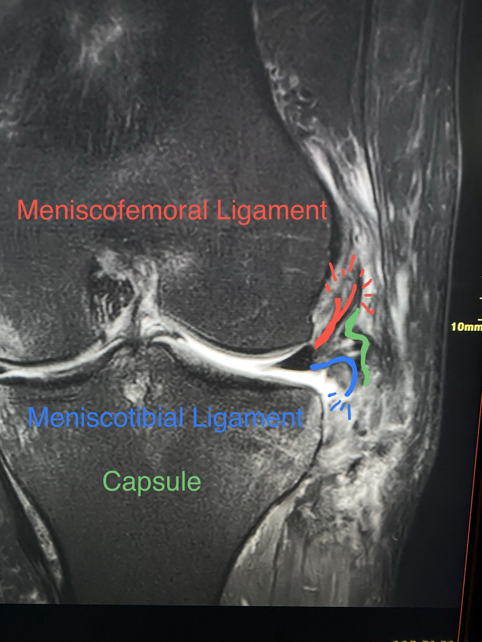 Anterior Meniscofemoral Ligament