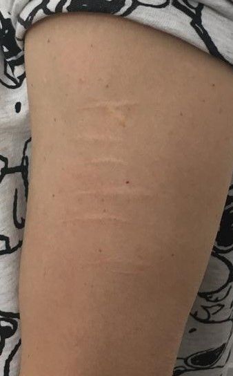 Self Harm Scars On Thighs Cultured Epithelial Cell Therapy