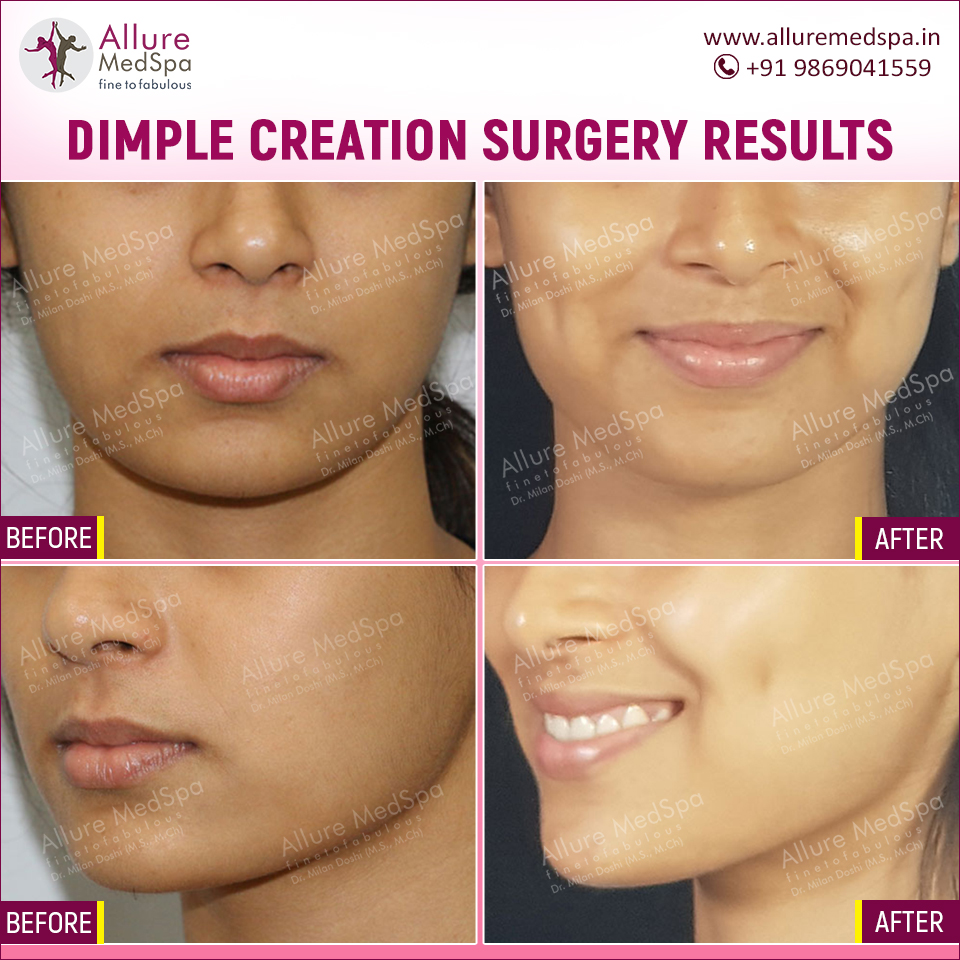 Dimple Surgery Before And After