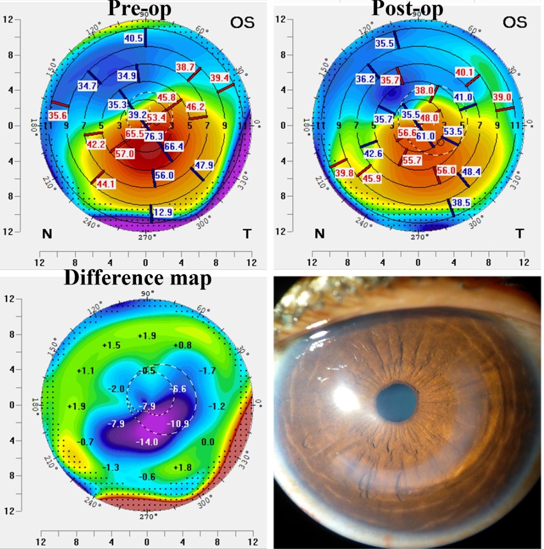 Intacs Keratoconus
