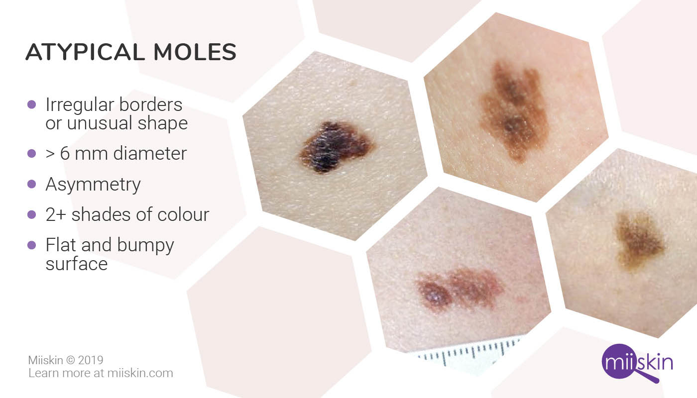 Melanoma Mole Vs Normal Mole