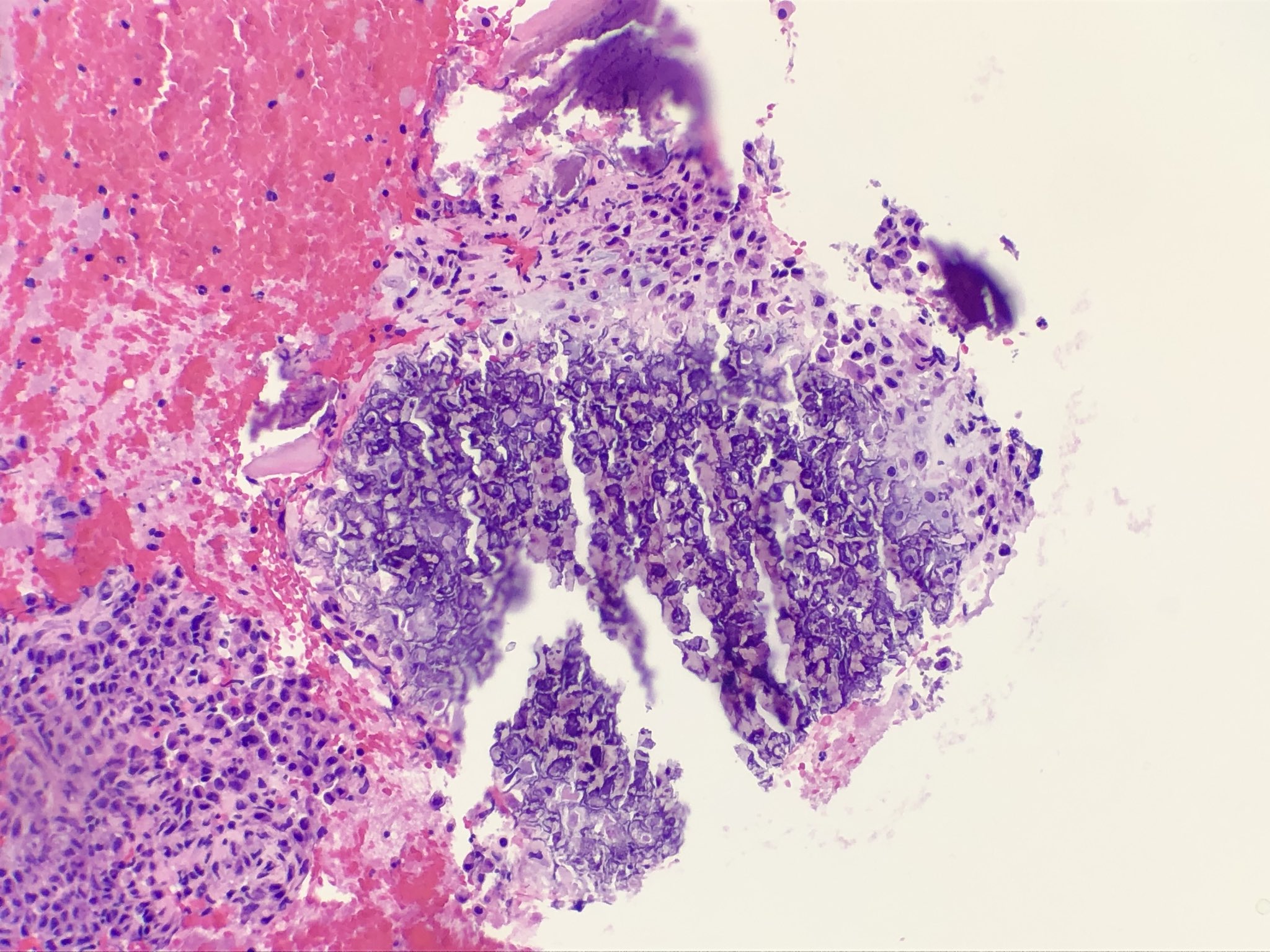 Chondroblastoma Chicken Wire