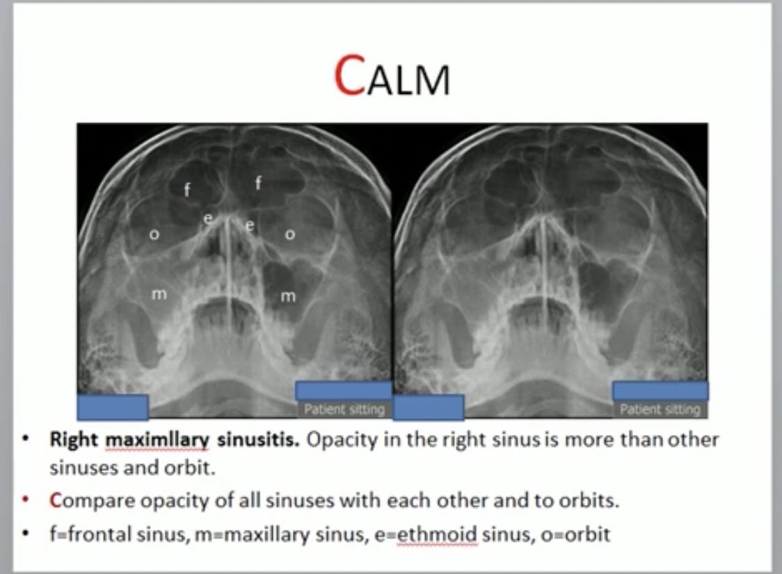 Paranasal Sinuses X Ray