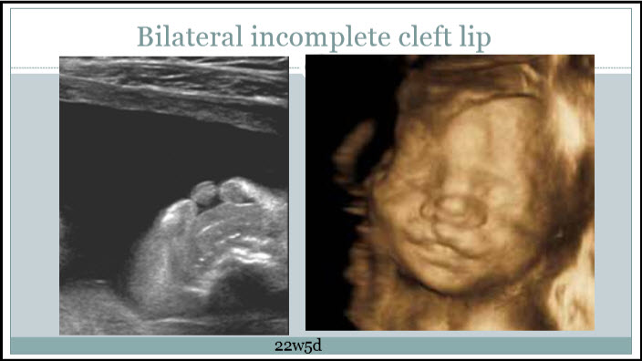 Bilateral Cleft Lip Ultrasound