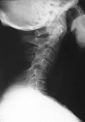 Bilateral Facet Dislocation