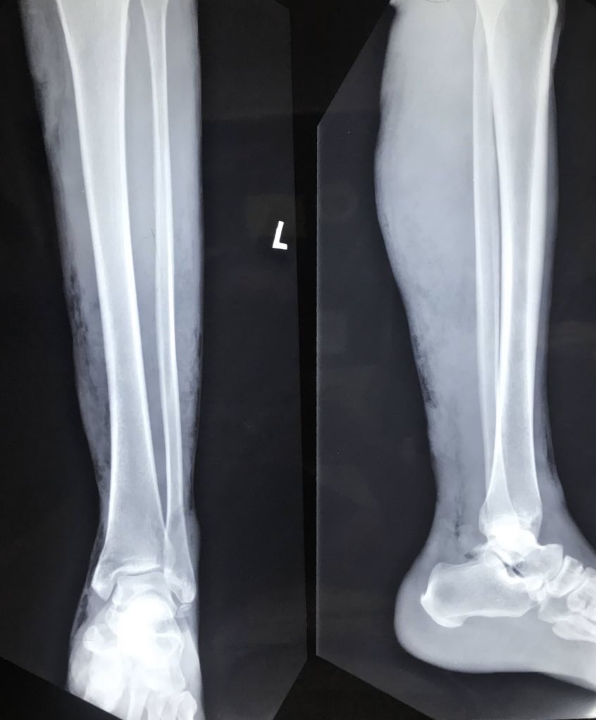 Necrotizing Fasciitis Xray