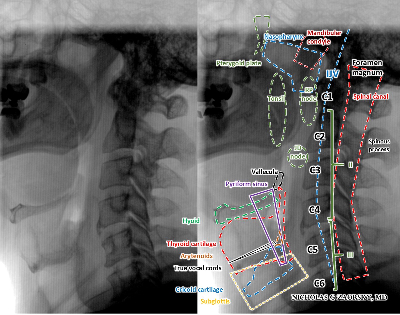 Thyroid Cartilage Xray Radiographic Positioning Techniques For The