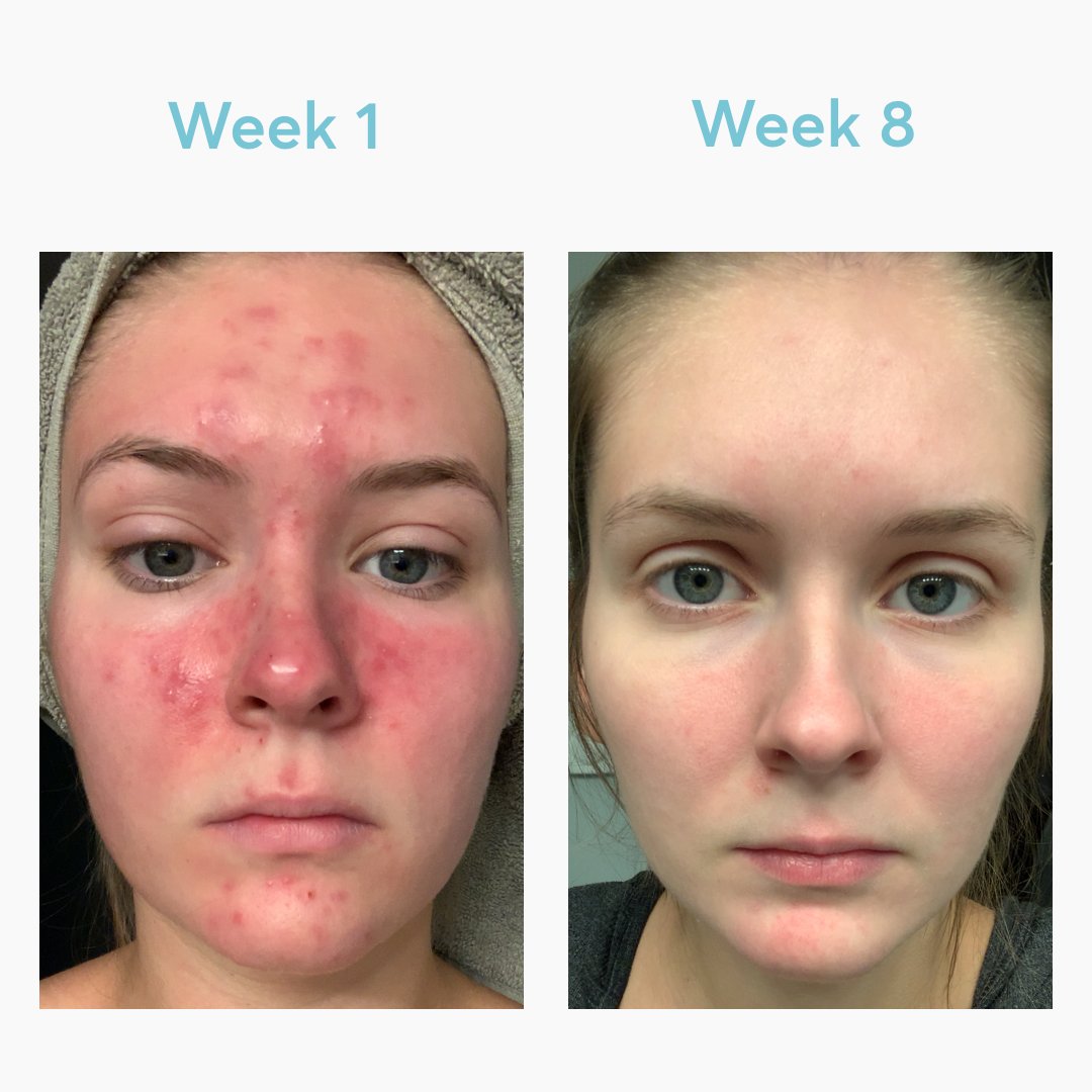 Does Makeup Make Acne Worse