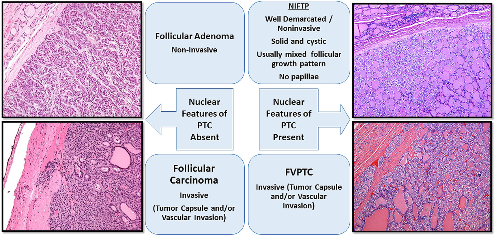 Thyroid Adenoma Histology