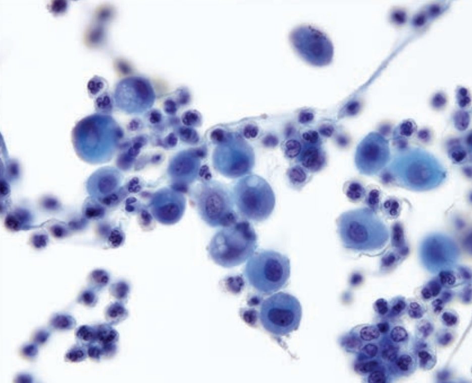 Atrophic Vaginitis Cytology